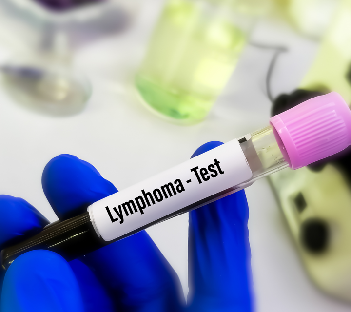 Lymphoma